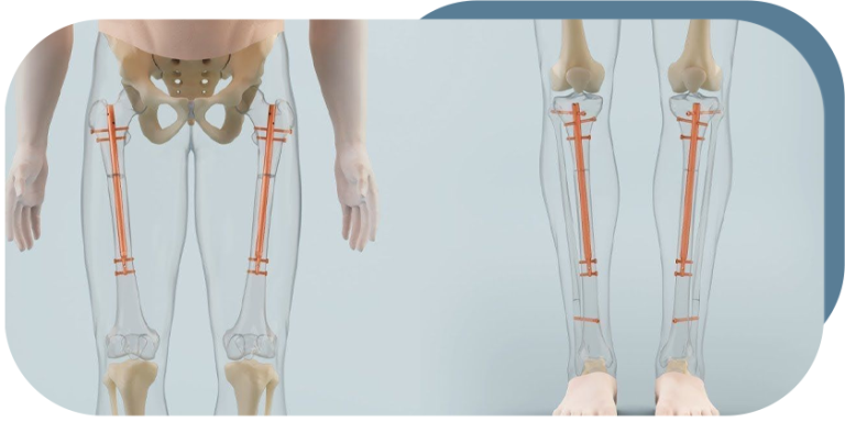 Limb Lengthening Surgery in Turkey Cost 2025 | Mydora Health CareMydora ...